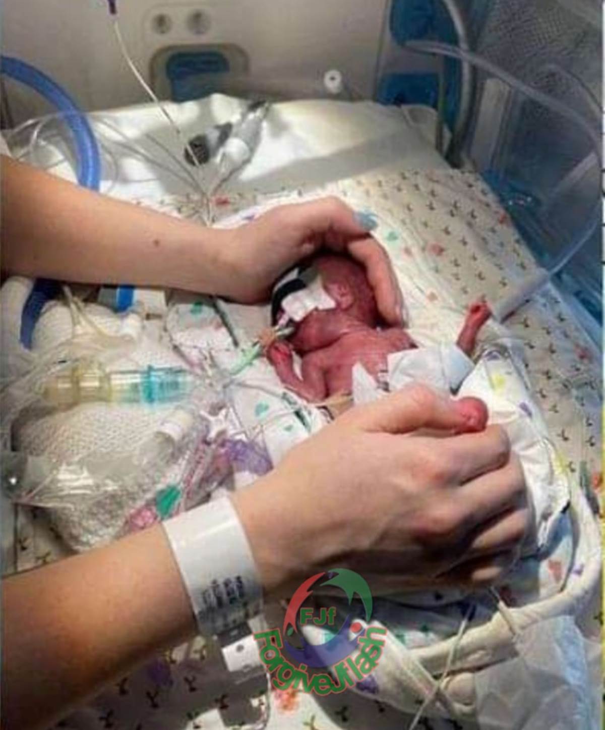 Beba rođena sa pola kilograma kako izgleda danas | Yumama