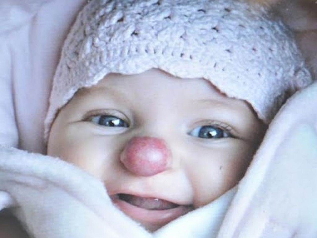 Kako danas izgleda beba rođena sa klovn nosem | Yumama