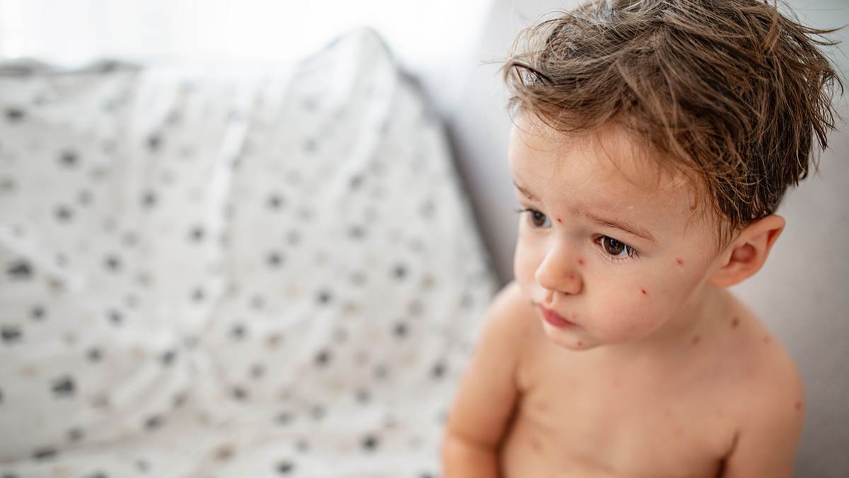 kako izgleda početak boginja kod dece | Yumama