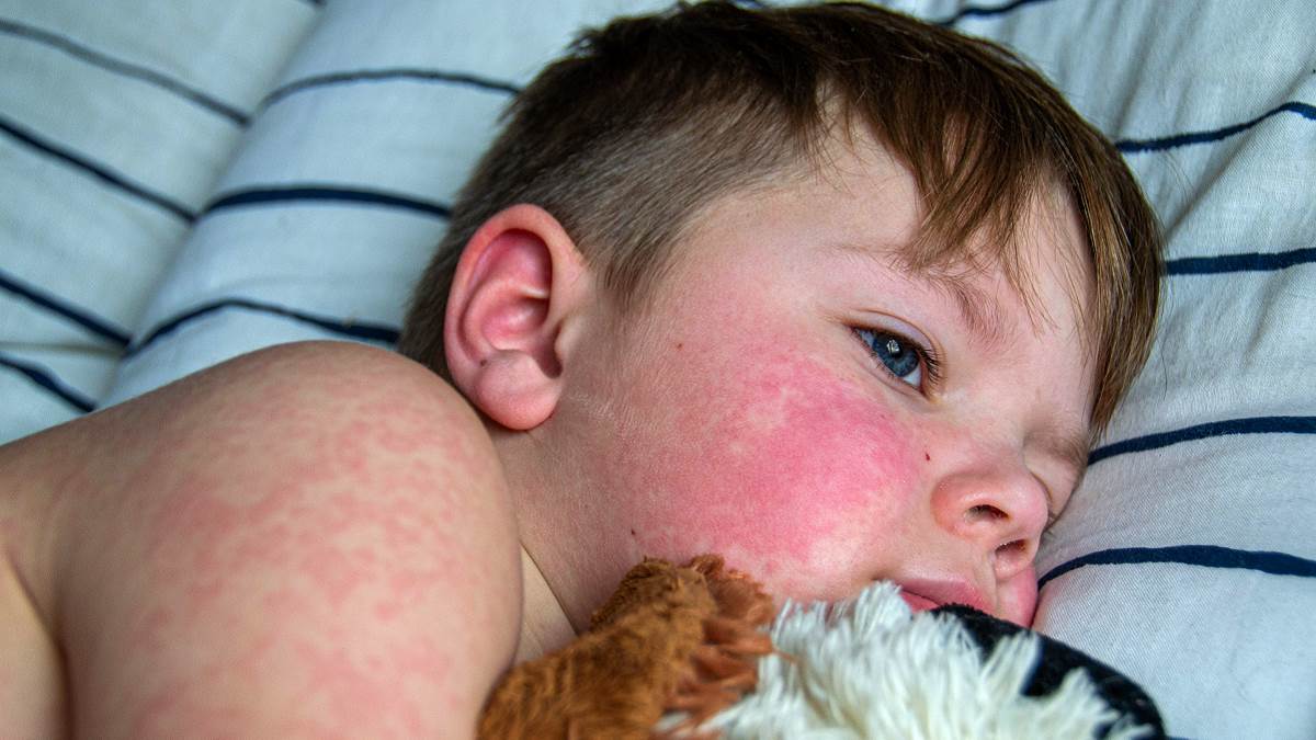virusni osip kod dece slike | Yumama
