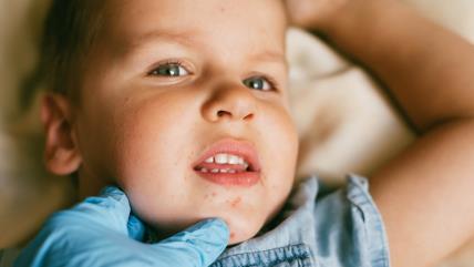 osip oko usta kod dece uzroci i lečenje | Yumama